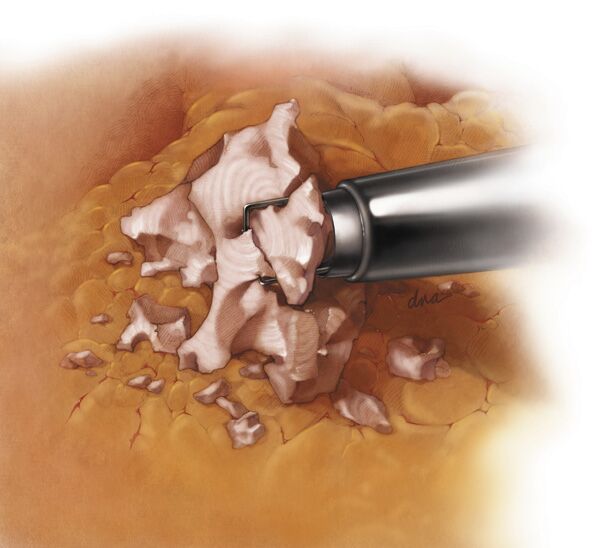 How Morcellators Spread Cancer | Morrow & Sheppard